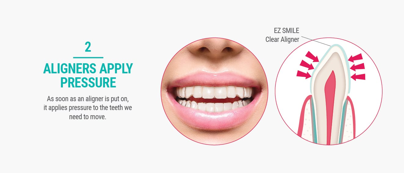 Understanding How Clear Aligners Straighten Teeth | EZ SMILE