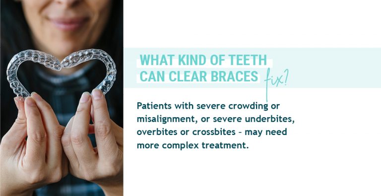 Understanding Clear Aligners: Do They Push Teeth Back? | EZ SMILE